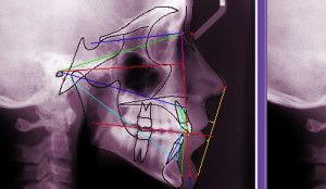 Ceph Tracing - Johns Dental Lab