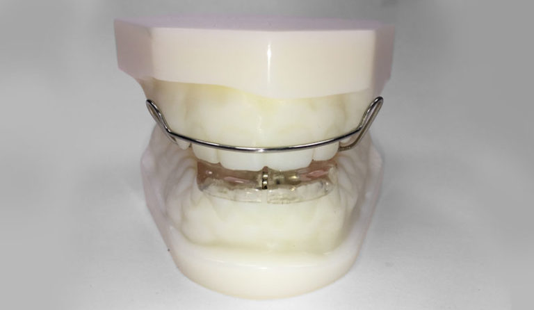 Bionator - Johns Dental Lab