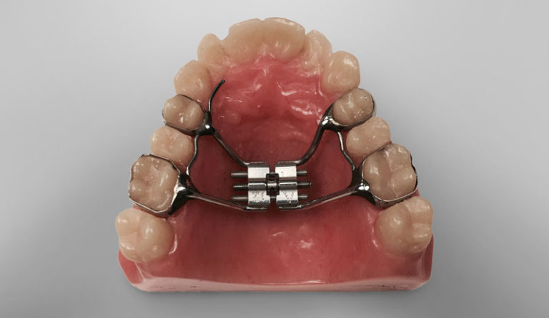 Hyrax - Johns Dental Lab