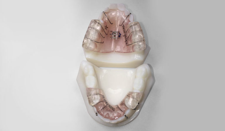 Twin Block - Johns Dental Lab