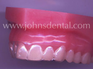 Essix - Johns Dental Lab