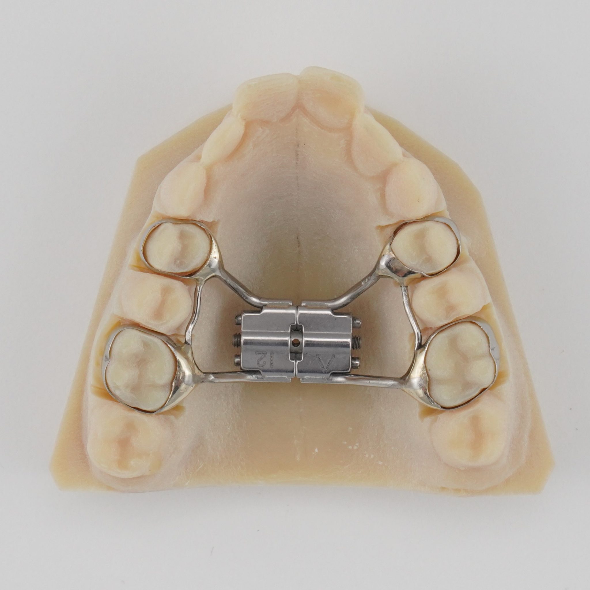 Hyrax - Johns Dental Lab