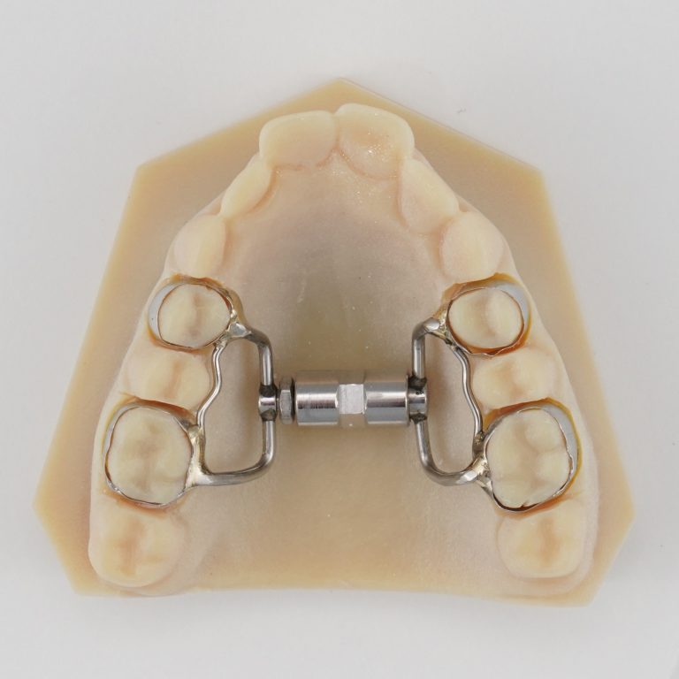 Hyrax - Johns Dental Lab